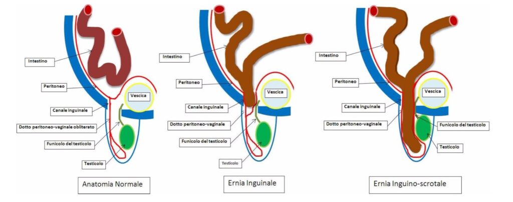 L’ernia inguinale in età pediatrica- Brescia Bimbi